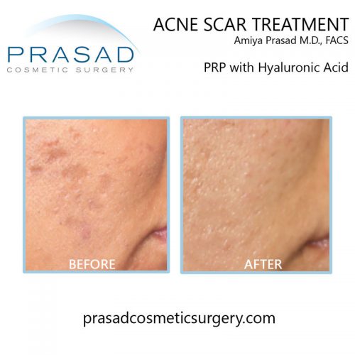 Acne Scars Treatment | NYC and Long Island | Prasad Cosmetic Surgery