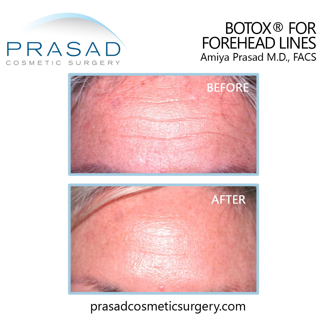 Best Botox® Treatment Garden City & NYC - Prasad Cosmetic Surgery