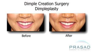 Dimple surgery | Dimple Creation | Learn More - New York