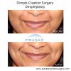 Dimple surgery | Dimple Creation | Learn More - New York