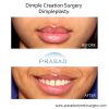 Dimple surgery | Dimple Creation | Learn More - New York