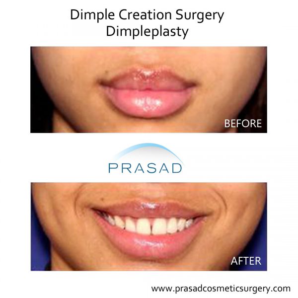 Dimple surgery | Dimple Creation | Learn More - New York