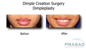 Dimple surgery | Dimple Creation | Learn More - New York