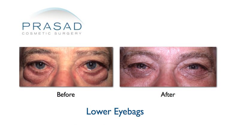 Eye Bag Removal Surgery: Procedure, Risks, Recovery