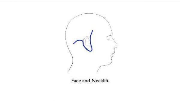 Best Facelift in NYC and Long Island New York - Dr. Amiya Prasad