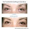 Under Eye Fat Transfer: Possible Complications & Safer Alternative