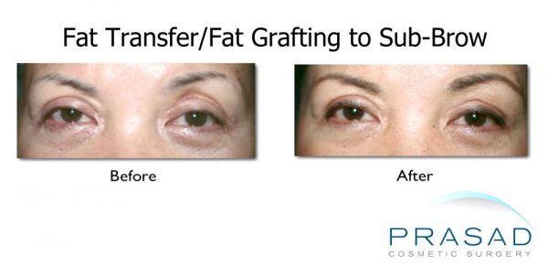 Under Eye Fat Transfer: Possible Complications & Safer Alternative
