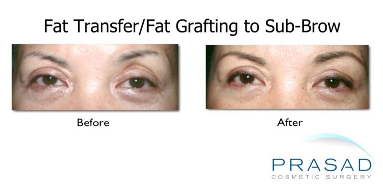Under Eye Fat Transfer: Possible Complications & Safer Alternative