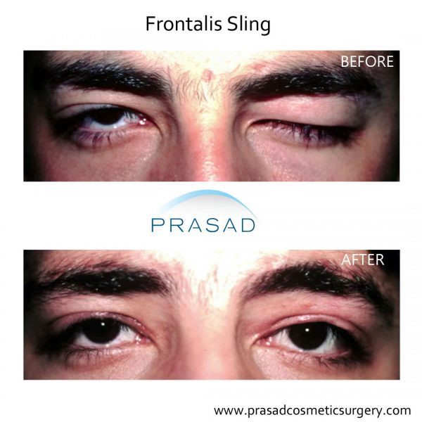Ptosis Surgery | Eyelid Droop Correction New York - Amiya Prasad MD