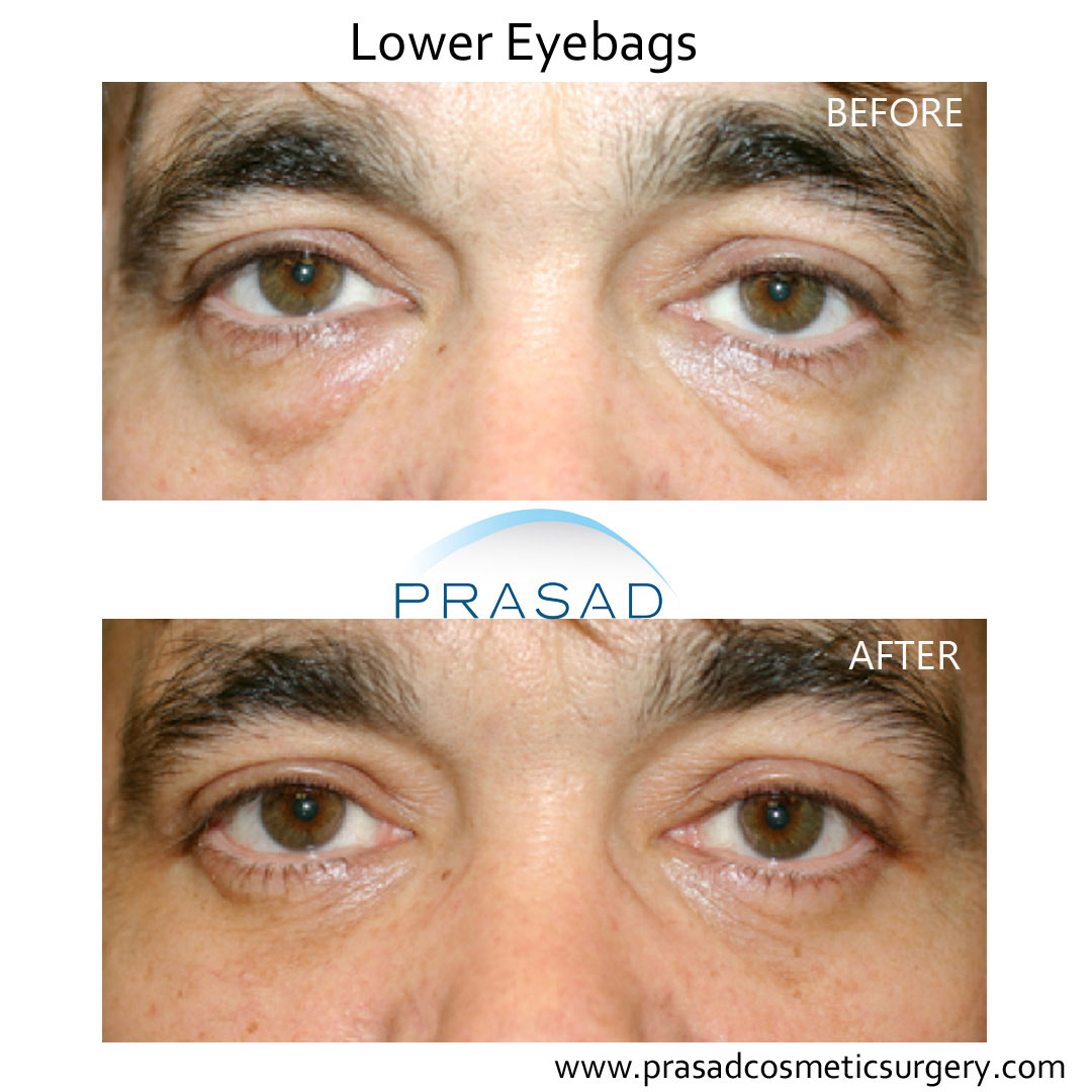 Transconjunctival Blepharoplasty | Eyelid surgery - New York City