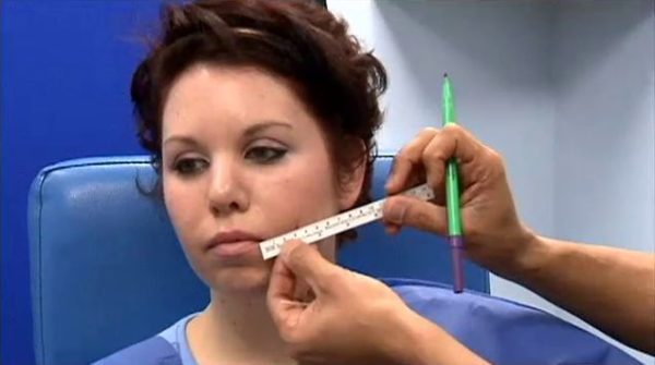 Dimple surgery | Dimple Creation Surgery - New York