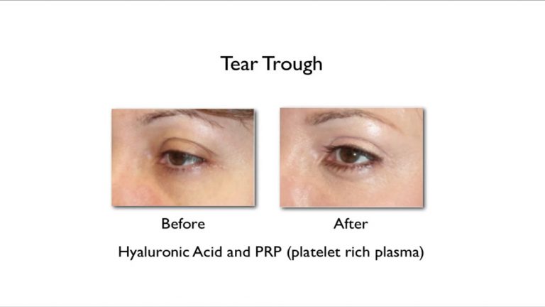 Under Eye Filler for Hollow Eyes, Tear Troughs and Eye Bags
