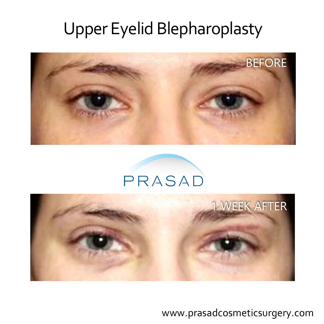 Upper Blepharoplasty / Upper Eyelid Surgery | Dr. Amiya Prasad