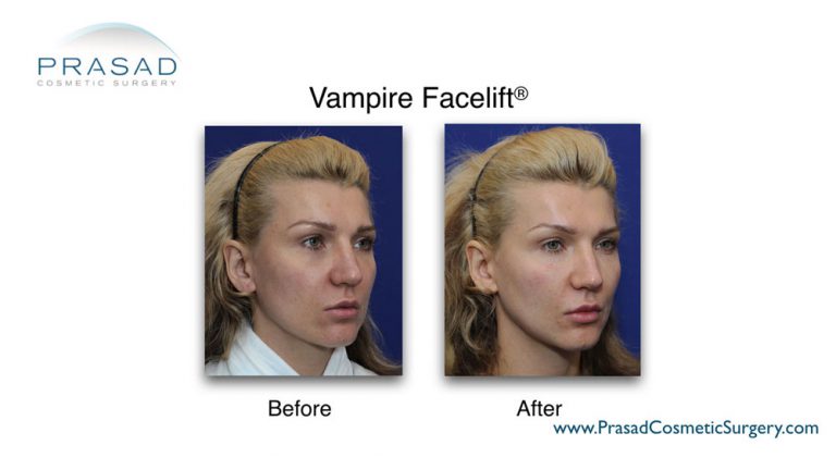 Vampire Facelift– Quick Facial Rejuvenation | New York