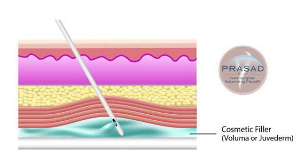 Y Lift® Non-Surgical Facelift - Dr. Amiya Prasad | New York