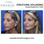 Y Lift® Non-Surgical Facelift - Dr. Amiya Prasad | New York