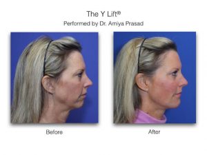Y Lift® Non-Surgical Facelift - Dr. Amiya Prasad | New York