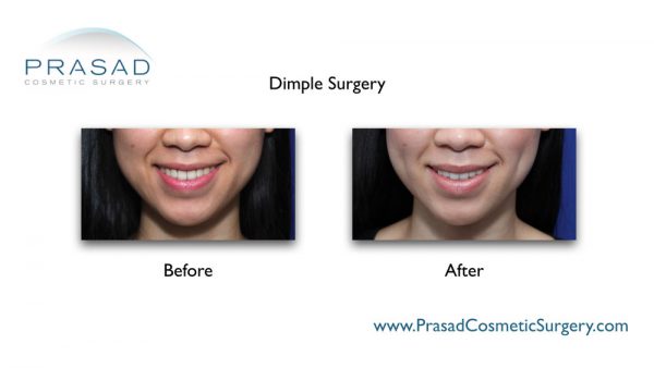 Dimple surgery | Dimple Creation | Learn More - New York