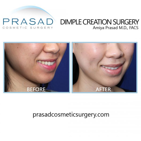 Dimple surgery | Dimple Creation | Learn More - New York