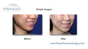 Dimple surgery | Dimple Creation | Learn More - New York