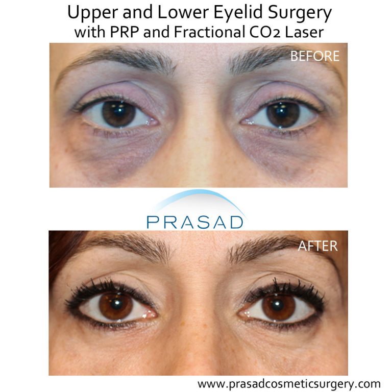 Eyelid Retraction: What It Is, Why It Happens, and How to Avoid It