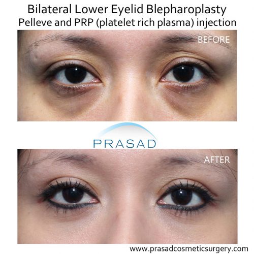 Benefits of PRP Injection Under Eyes - Dr. Prasad | New York
