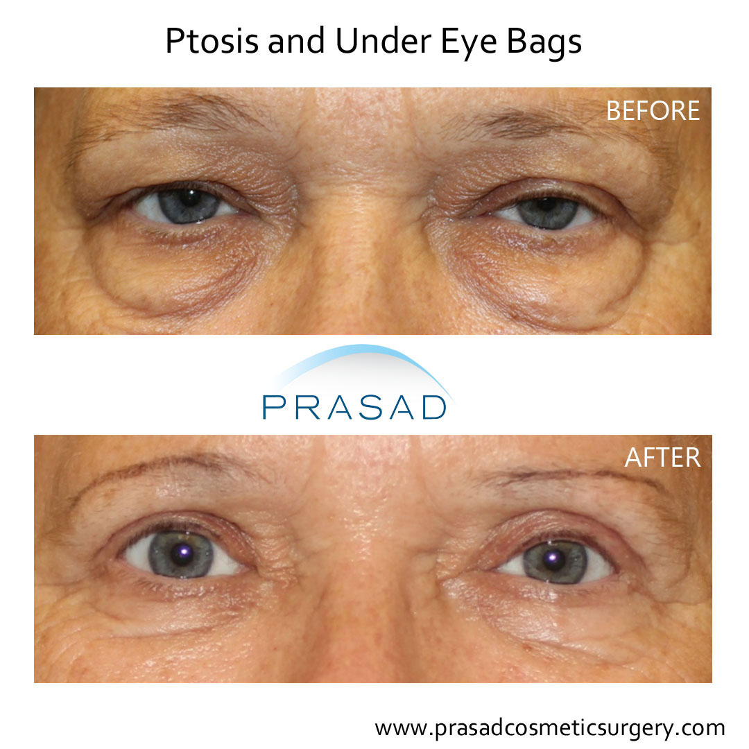Under Eye Bag - Causes, Treatments, Surgery and Recovery