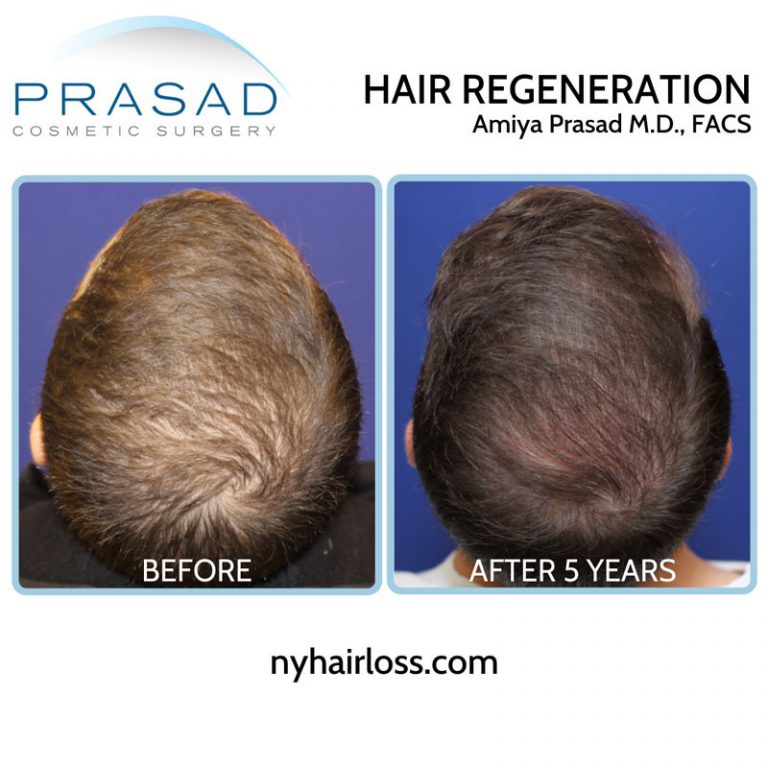 Differences Between Hair Shedding vs Hair Loss (Hair Fall)