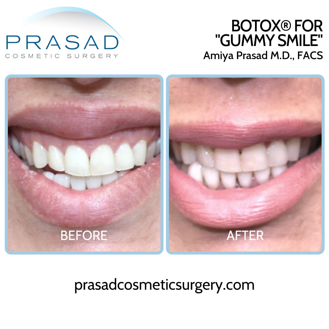 Best Lip Enhancement | Lip Fillers in NYC and Garden City