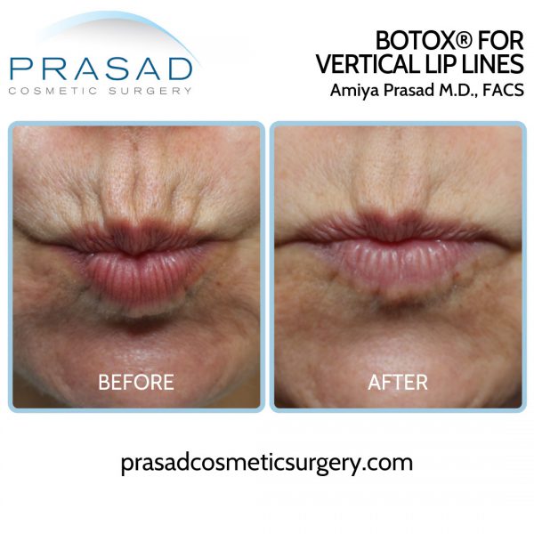 What’s the Best Treatment for Wrinkles Above Lips? | Dr. Prasad Blog