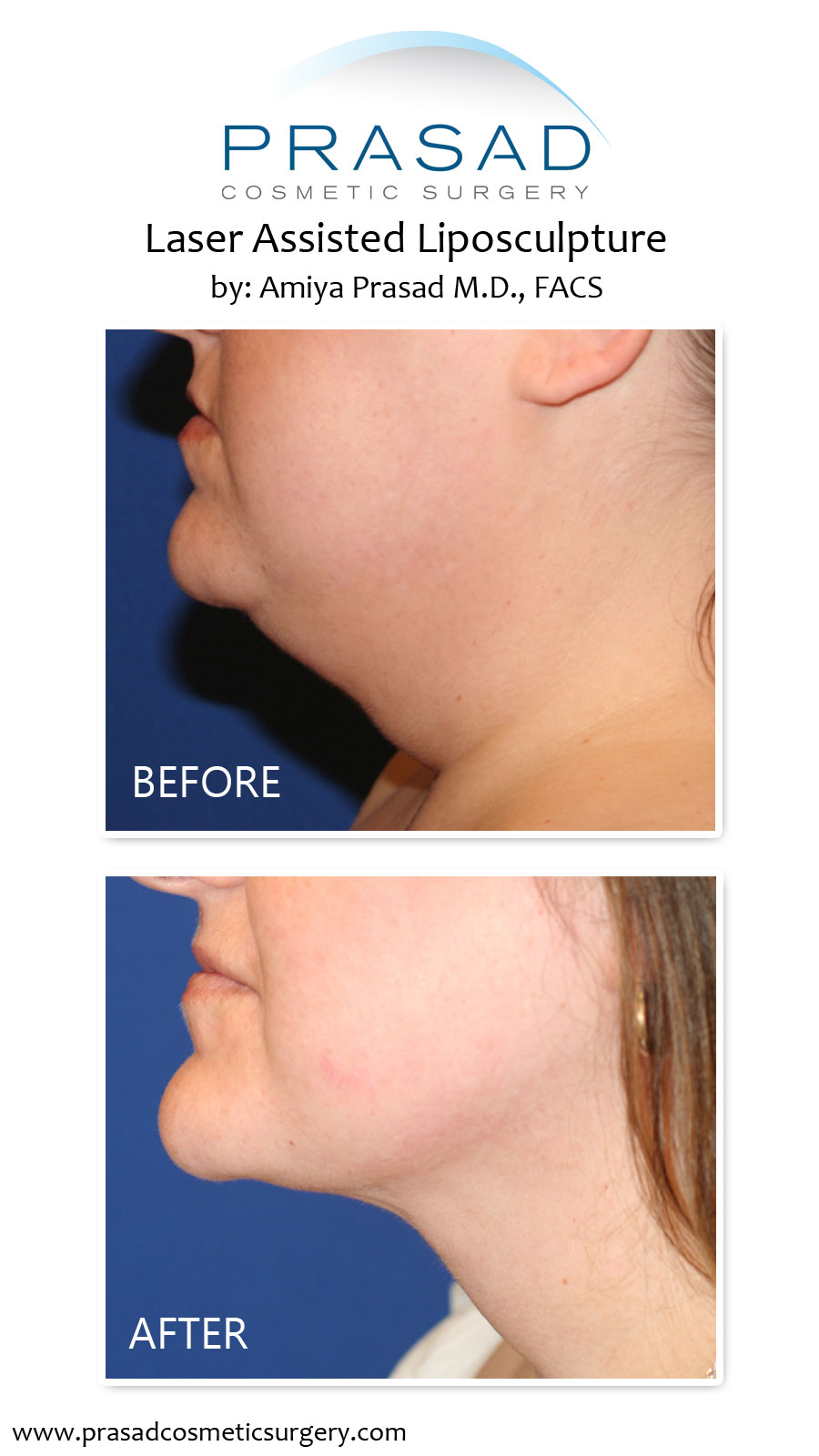 Liposuction NYC | New York Lipo Expert - Dr. Amiya Prasad