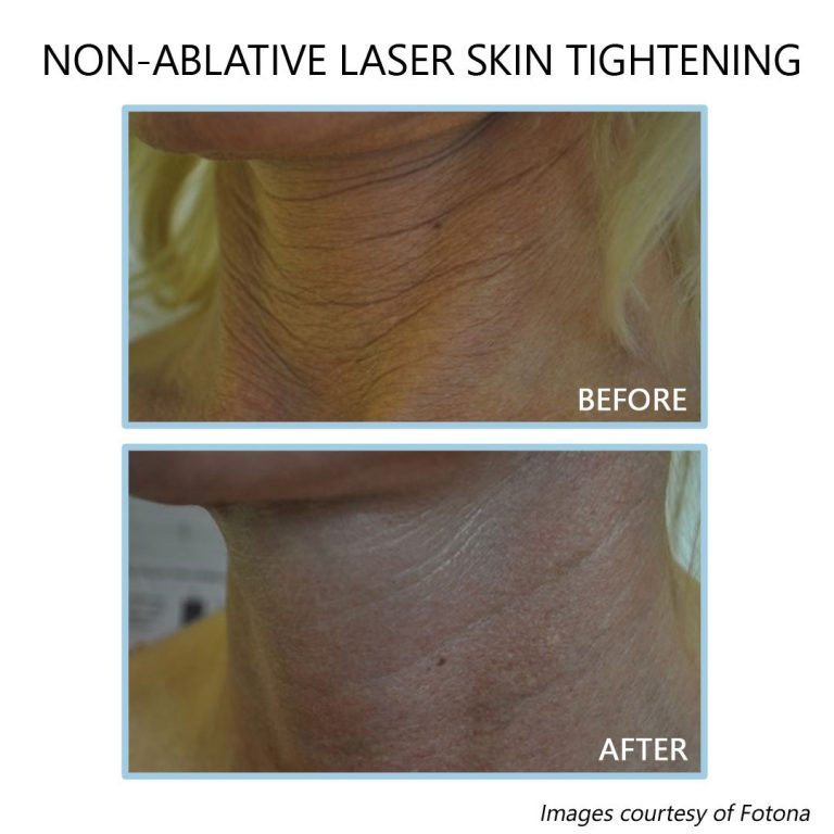 Body Laser Skin Tightening - NYC and Long Island New York