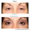 What Causes Heavy Lidded Eyes and How to Treat Them