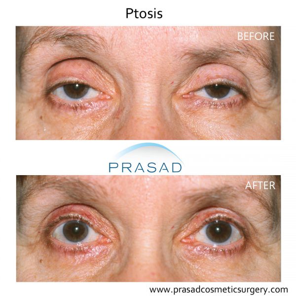 Ptosis Correction Surgery - Causes and Treatment | Dr Prasad Blog