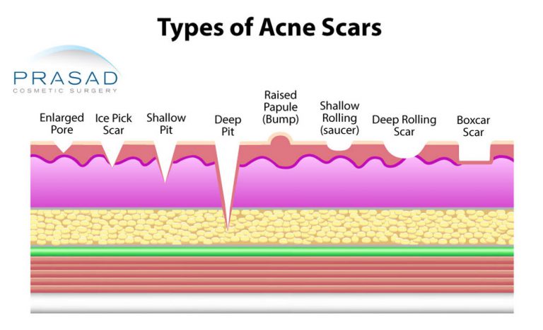 Acne Scars Treatment | NYC and Long Island | Prasad Cosmetic Surgery