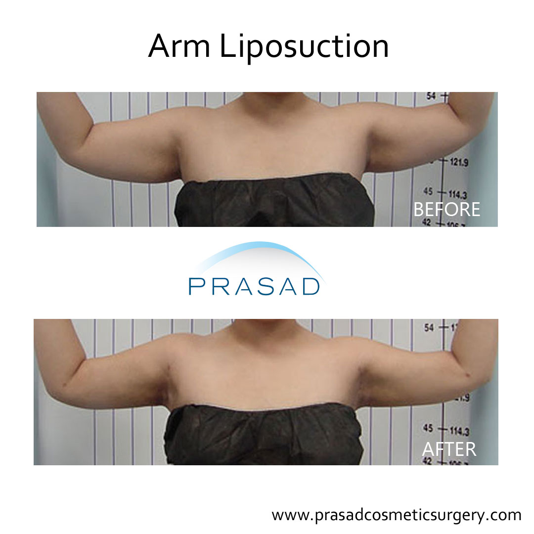 Liposuction NYC | New York Lipo Expert - Dr. Amiya Prasad