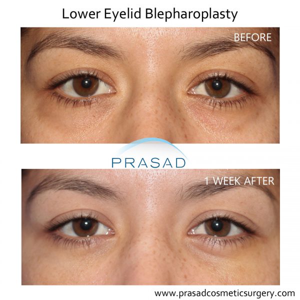 Lower Blepharoplasty Recovery Process | Dr. Prasad Blog