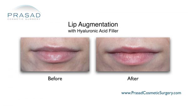 Semi-Permanent and Permanent Fillers: What You Need to Know
