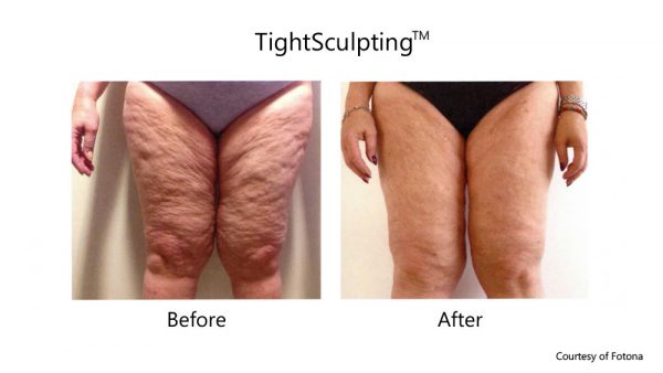 Body Laser Skin Tightening Nyc And Long Island New York