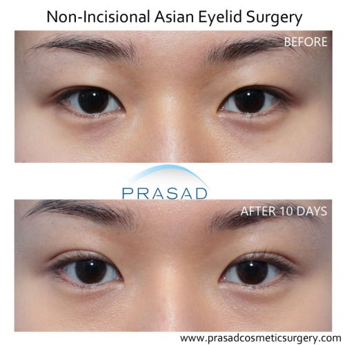 How Hooded Eye Surgery Scars are Minimized | Dr. Prasad Blog