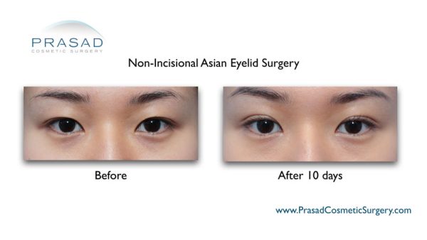 Why is One Eye Lower than the Other (Asian Uneven Eyelids)