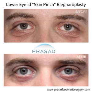 Does Lower Blepharoplasty Get Rid of Wrinkles? - Prasad Cosmetic Surgery