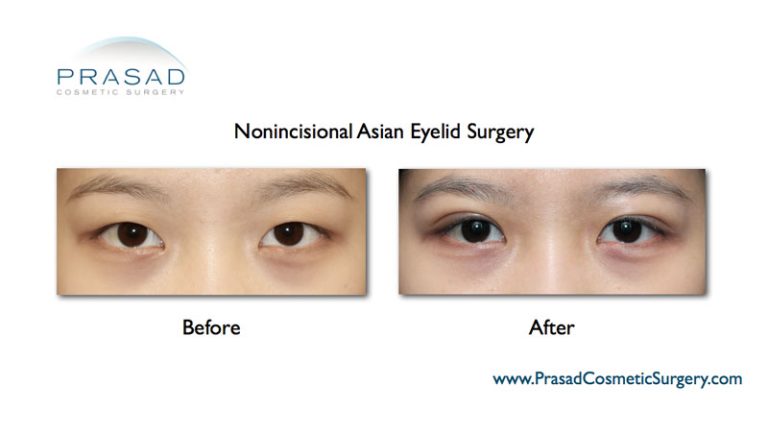 How is a Double Eyelid/ Eyelid Crease Created? | Dr. Prasad Blog