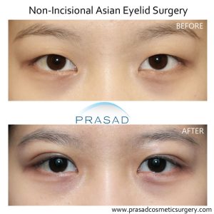 Parallel or Tapered Eyelid Crease for Asian Eye Surgery