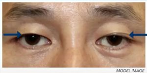 Why is One Eye Lower than the Other (Asian Uneven Eyelids)