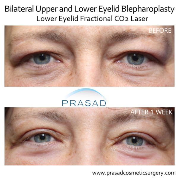 Under Eye Wrinkle Treatment Options - Dr. Prasad Blog