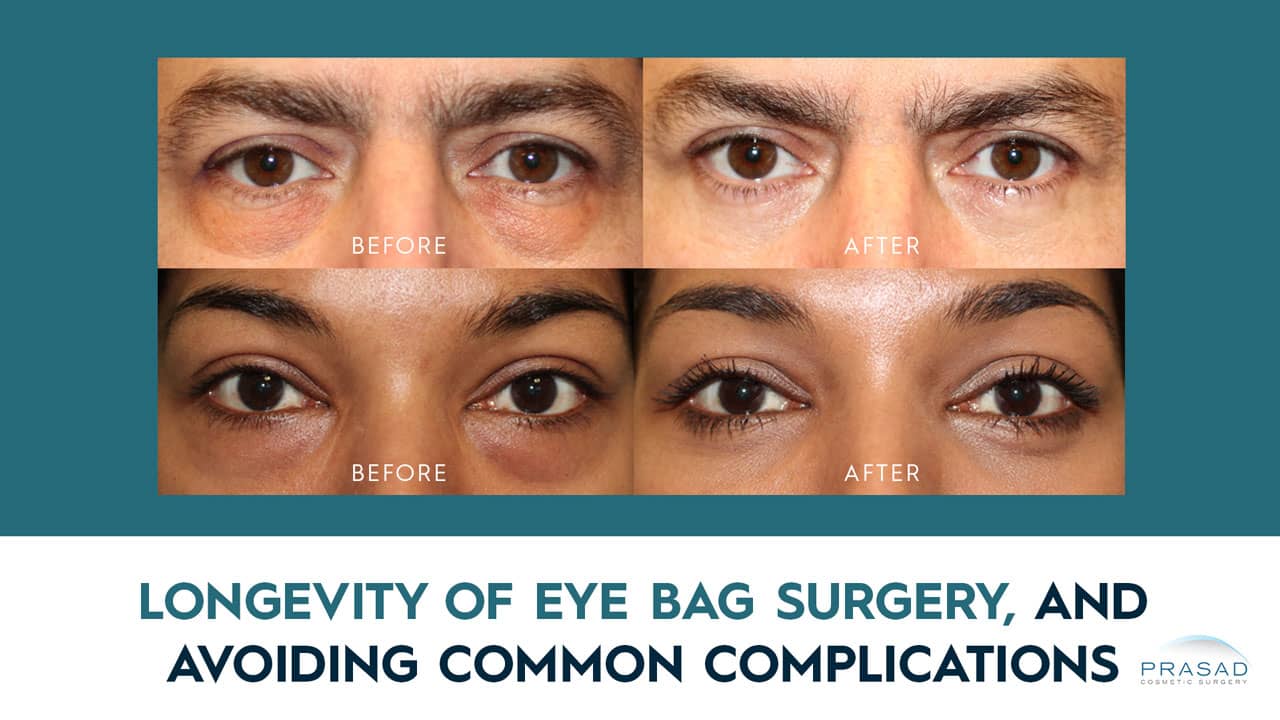 Facelift Surgery and Eyelid Surgery by Dr. Amiya Prasad, New York