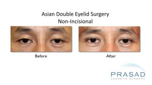 How is a Double Eyelid/ Eyelid Crease Created? | Dr. Prasad Blog