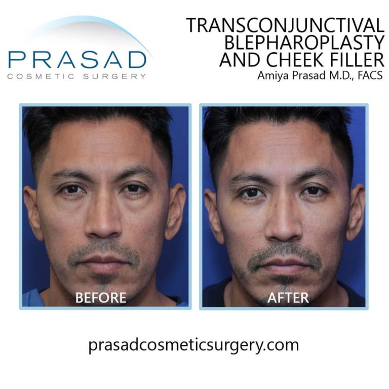 Cheek Filler Before and After, and What You Need to Know