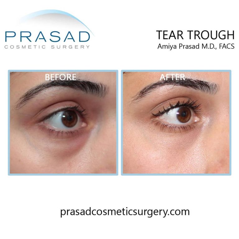 Effective Treatment Options for Bags Under the Eyes | Dr. Prasad Blog
